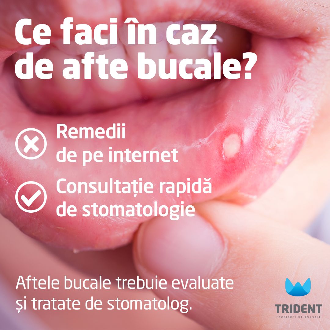 Tratamentul rapid al aftelor bucale - Clinica Trident