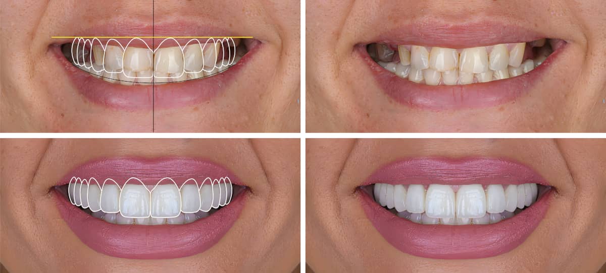 Cum arată un zâmbet „before and after” tratamentul cu fațete dentare ...